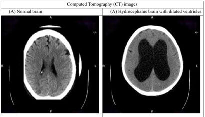 Hydrocephalus
