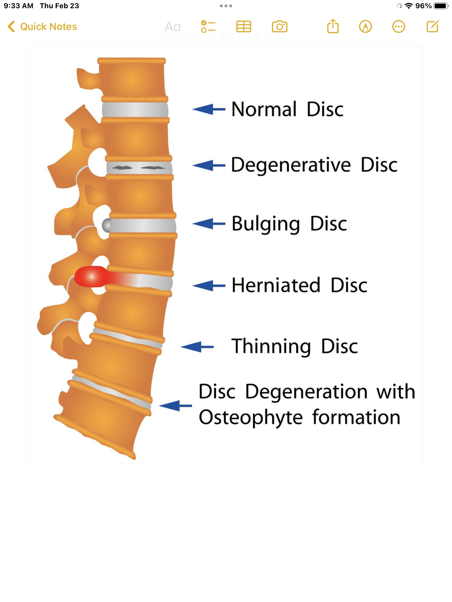 Intervertebral disc