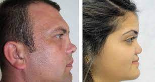 Saddle nose deformity