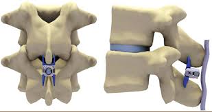 Interspinous spacers
