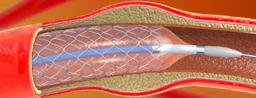 Percutaneous coronary intervention (PCI)