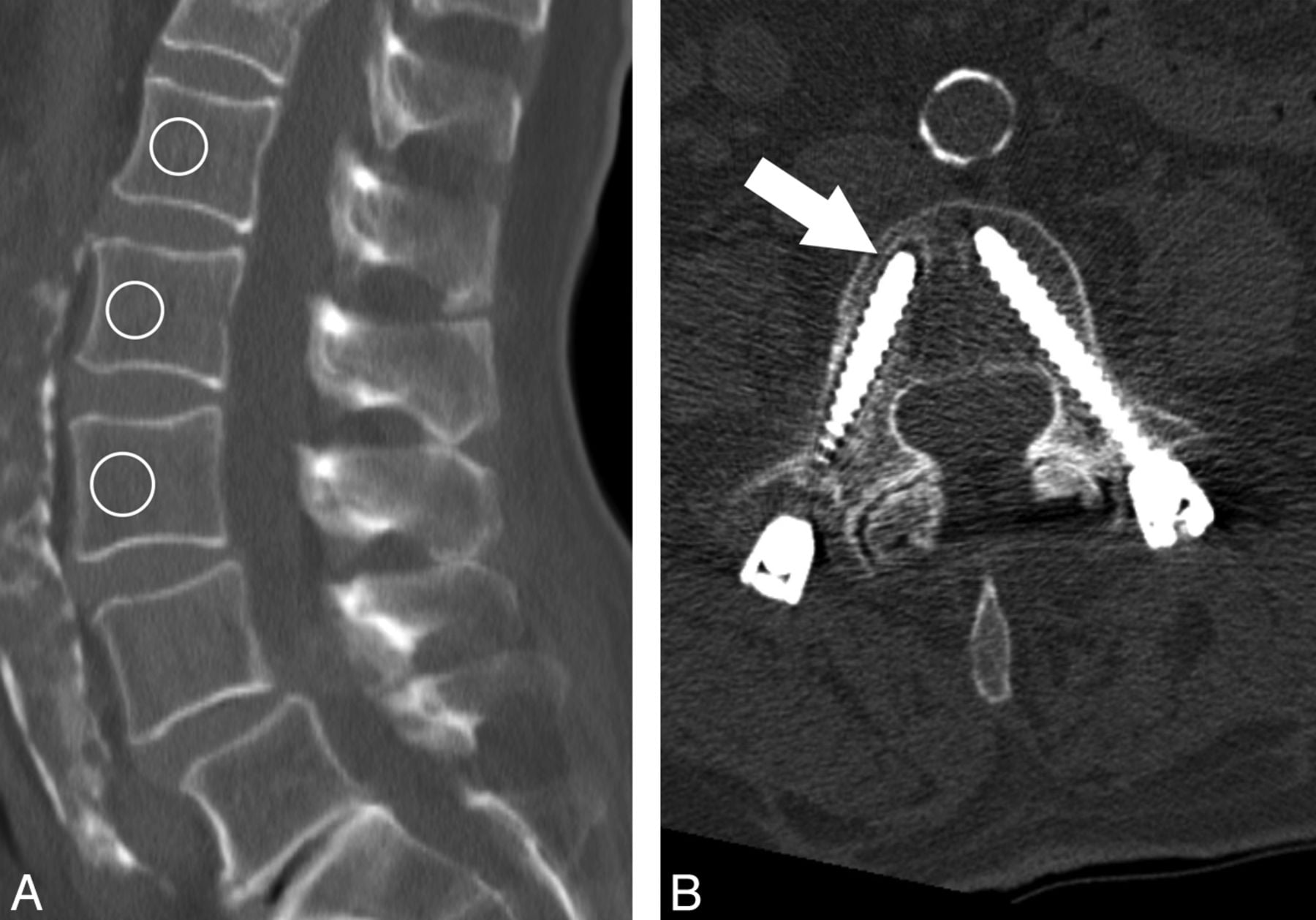 Loose screws in spinal fusion