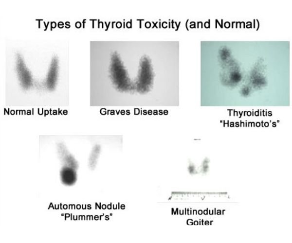 Radioactive Iodine Uptake Test Radioactive Iodine Uptake Test