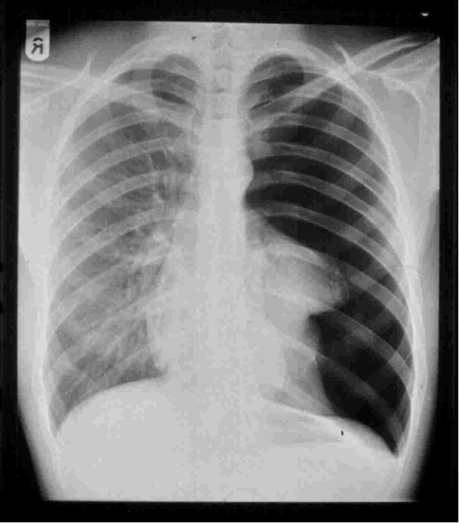 Pneumothorax