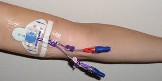 Venous access