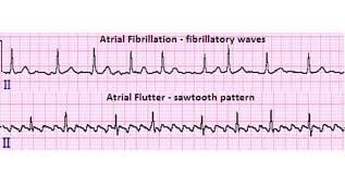 Atrial fibrillation vs atrial flutter